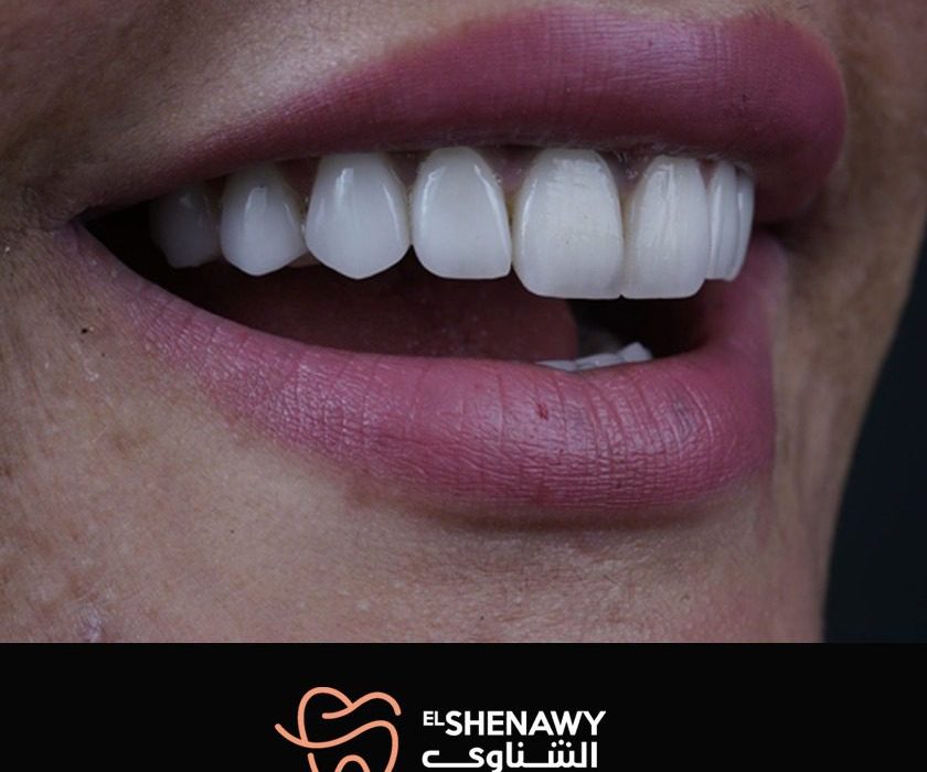 Cosmetic Fillings for Teeth: Show Your Smile | ‎El Shenawy Dental Center