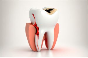 Exposed Nerve in Tooth: Causes, Symptoms & Treatment | ‎El Shenawy ...