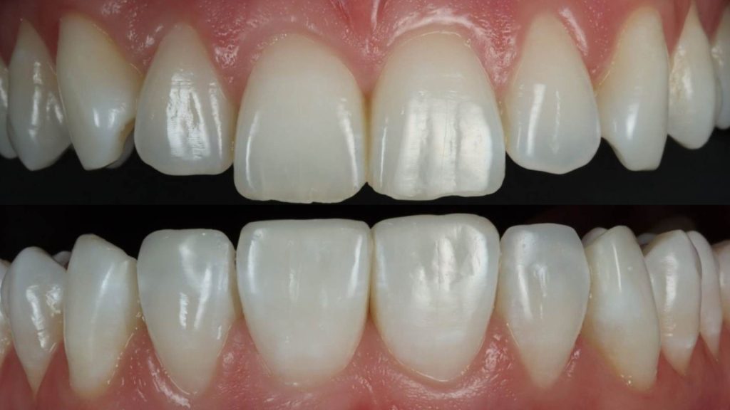 Exposed Nerve in Tooth: Causes, Symptoms & Treatment | ‎El Shenawy ...