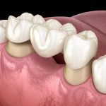 Fixed Dental Prosthesis: Types & Advantages | ‎El Shenawy Dental Center
