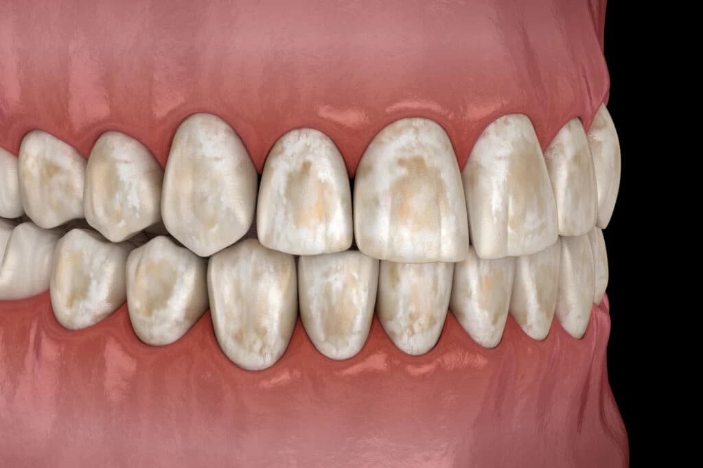 Brown Stain on Teeth: Causes and Treatments | ‎El Shenawy Dental Center