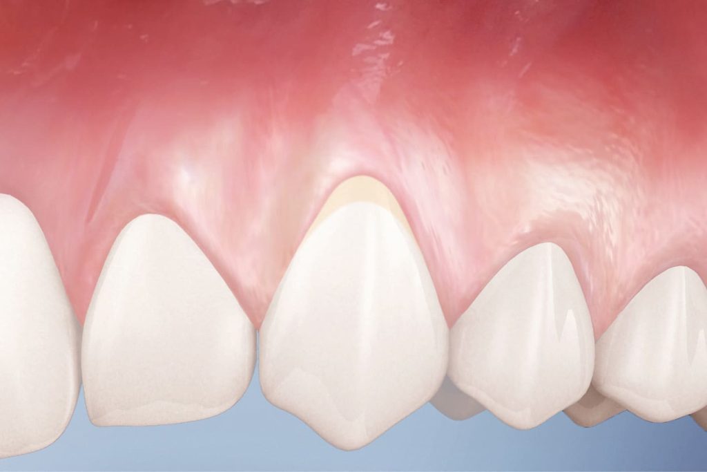 Exposed Nerve in Tooth: Causes, Symptoms & Treatment | ‎El Shenawy ...